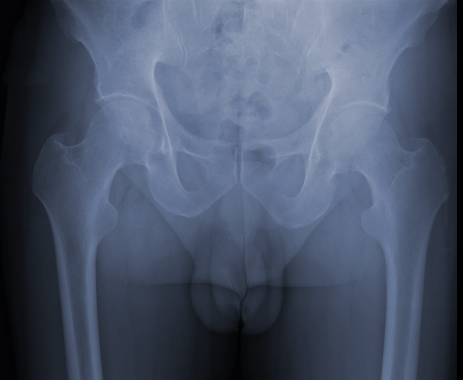 Radiografía de cadera - Clínica Magnasalud (Valencia)