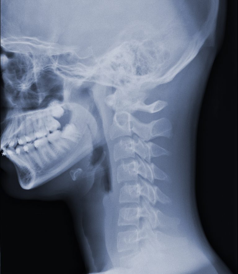 Radiografía de cervicales - Clínica Magnasalud (Valencia)