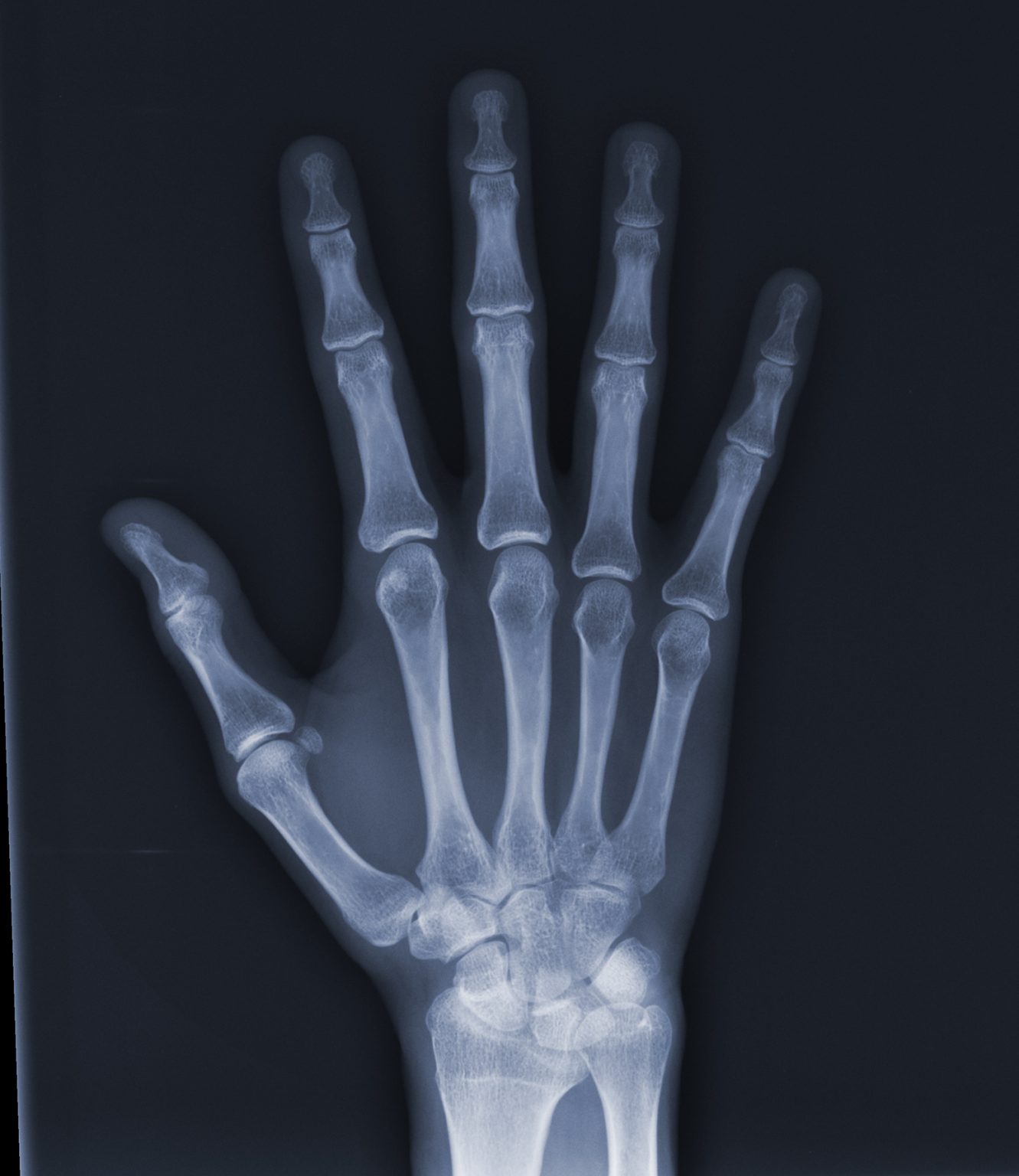 Radiografías de mano - Clínica Magnasalud (Valencia)