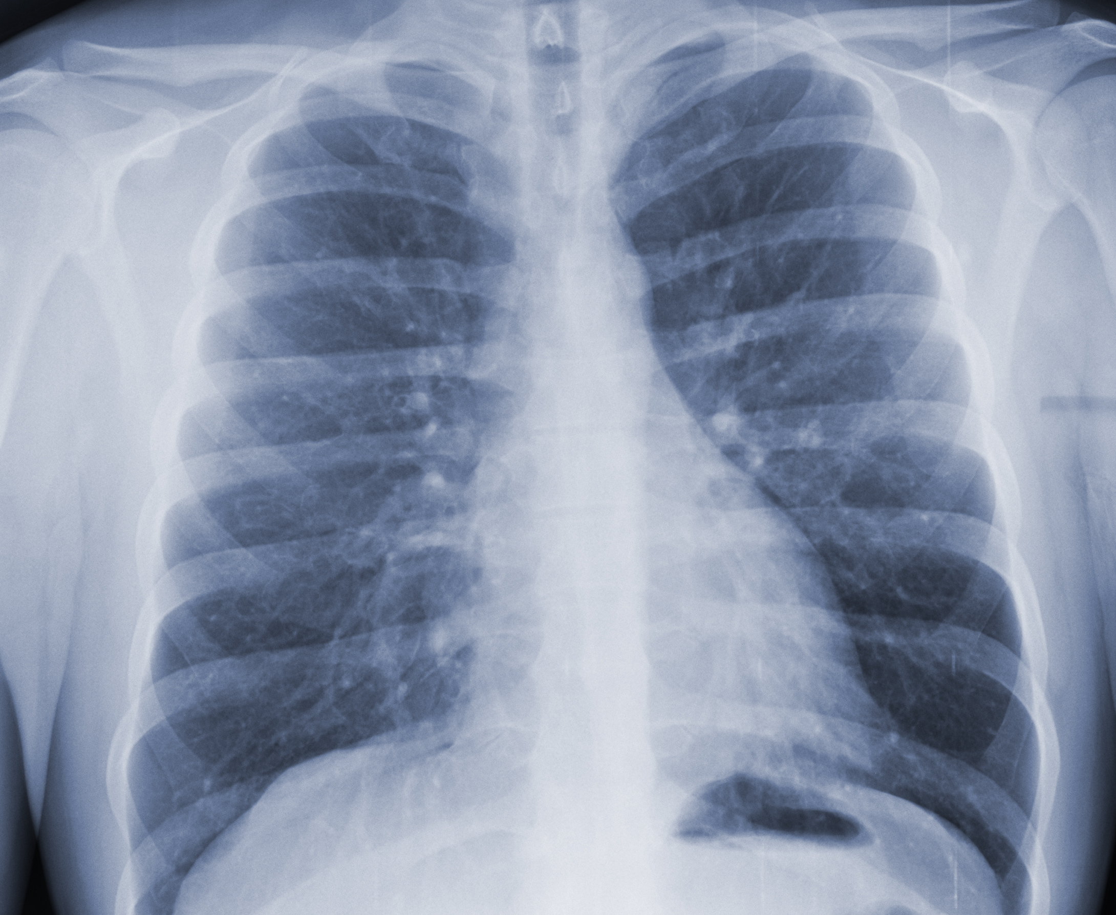 Radiografia De Torax Normal Rotulada Radiografía: Prueba Por