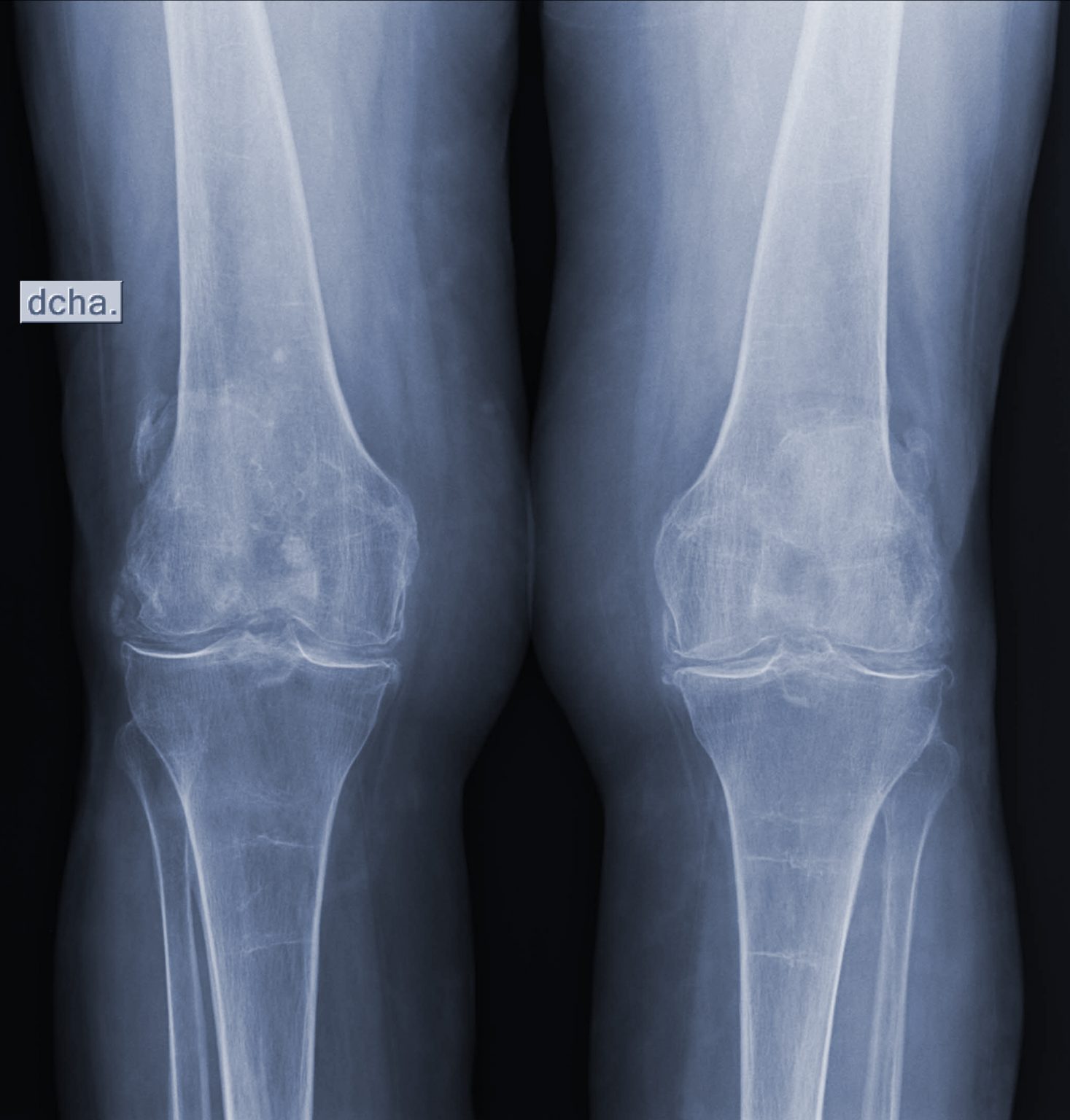 Radiografía de rodilla - Clínica Magnasalud (Valencia)