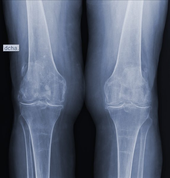 Radiografía de rodilla - Clínica Magnasalud (Valencia)