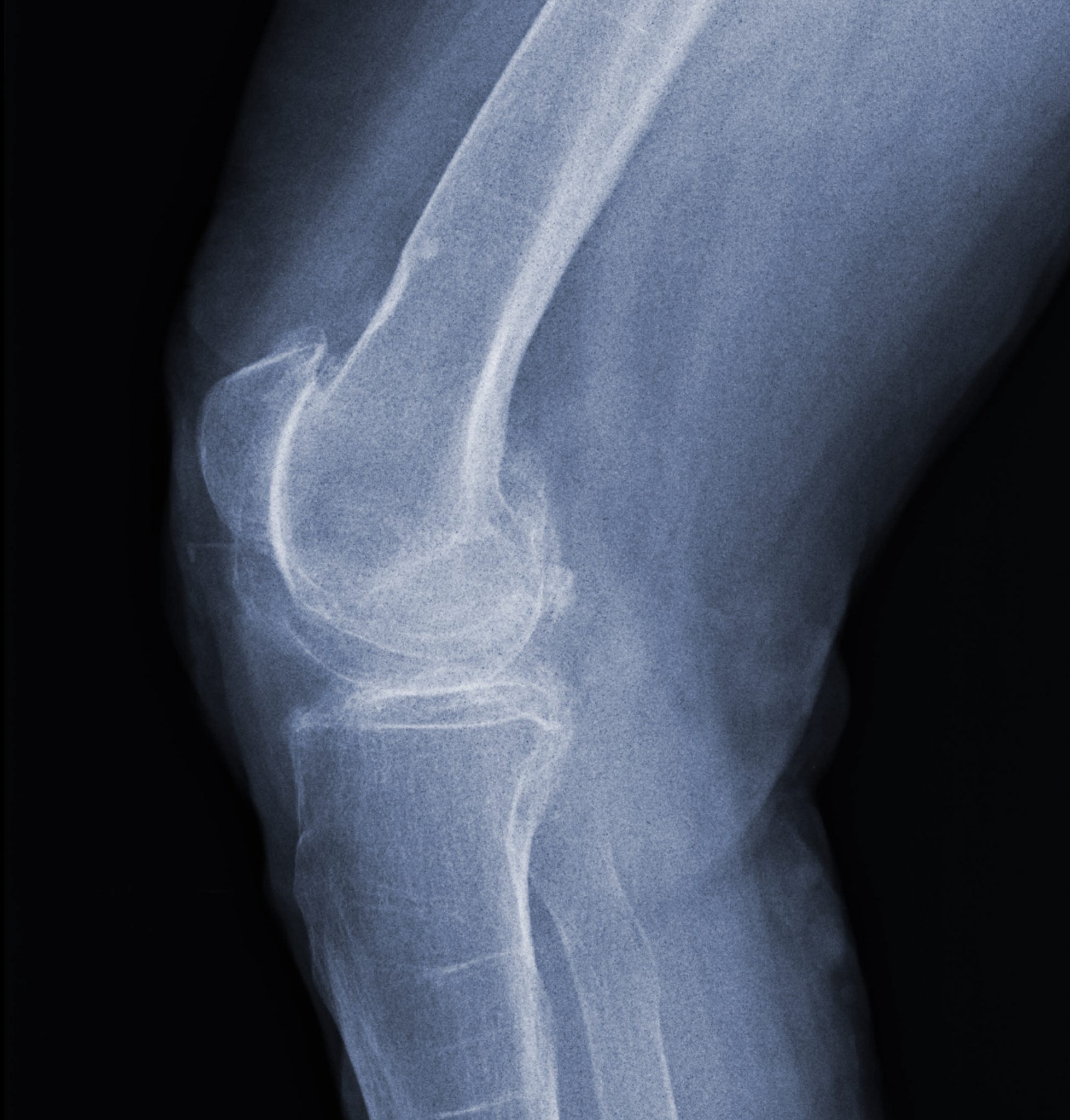 Radiografía de rodilla - Clínica Magnasalud (Valencia)